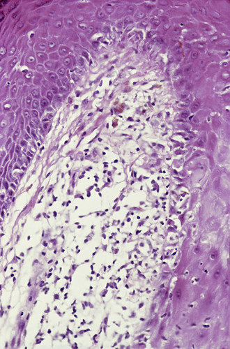 Lichen ruber planus Bilder Science Photo Library