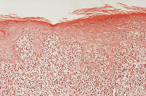 Lichen ruber planus Bilder Science Photo Library