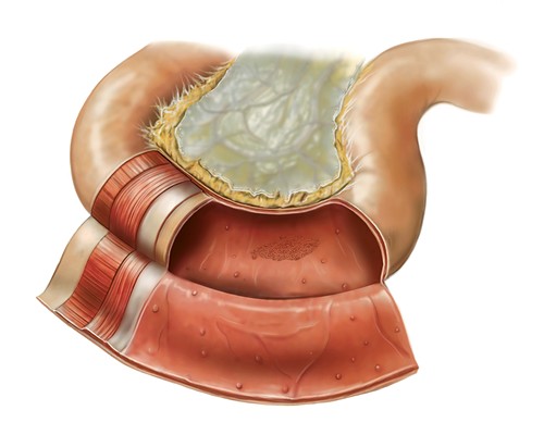 Ileum Bilder Science Photo Library