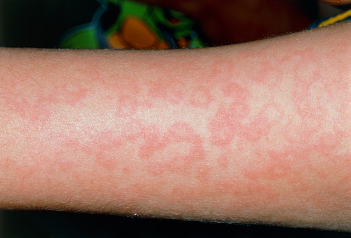 Erythema multiforme Bilder Science Photo Library