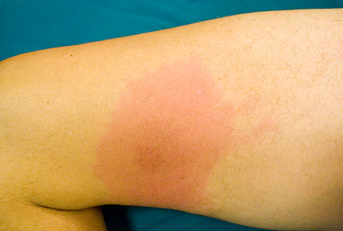 Erythema migrans Bilder Science Photo Library