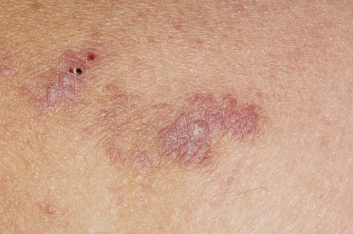 Lichen ruber planus Bilder Science Photo Library