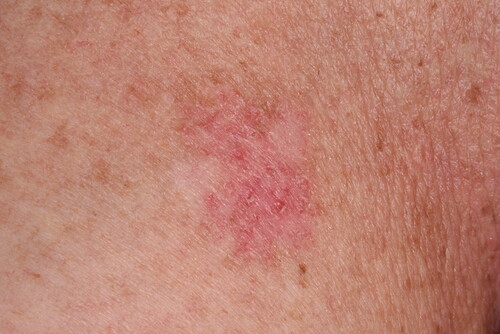 Carcinome basocellulaire Photos Science Photo Library