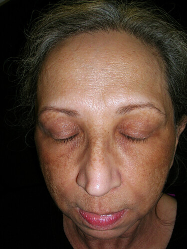 Lichen ruber planus Bilder Science Photo Library